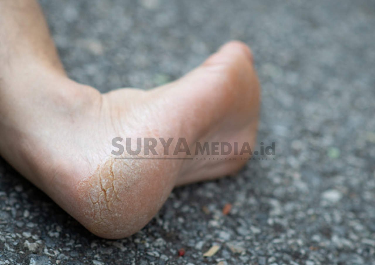 6 Cara Mudah Atasi Tumit Pecah-Pecah - Suryamedia.id